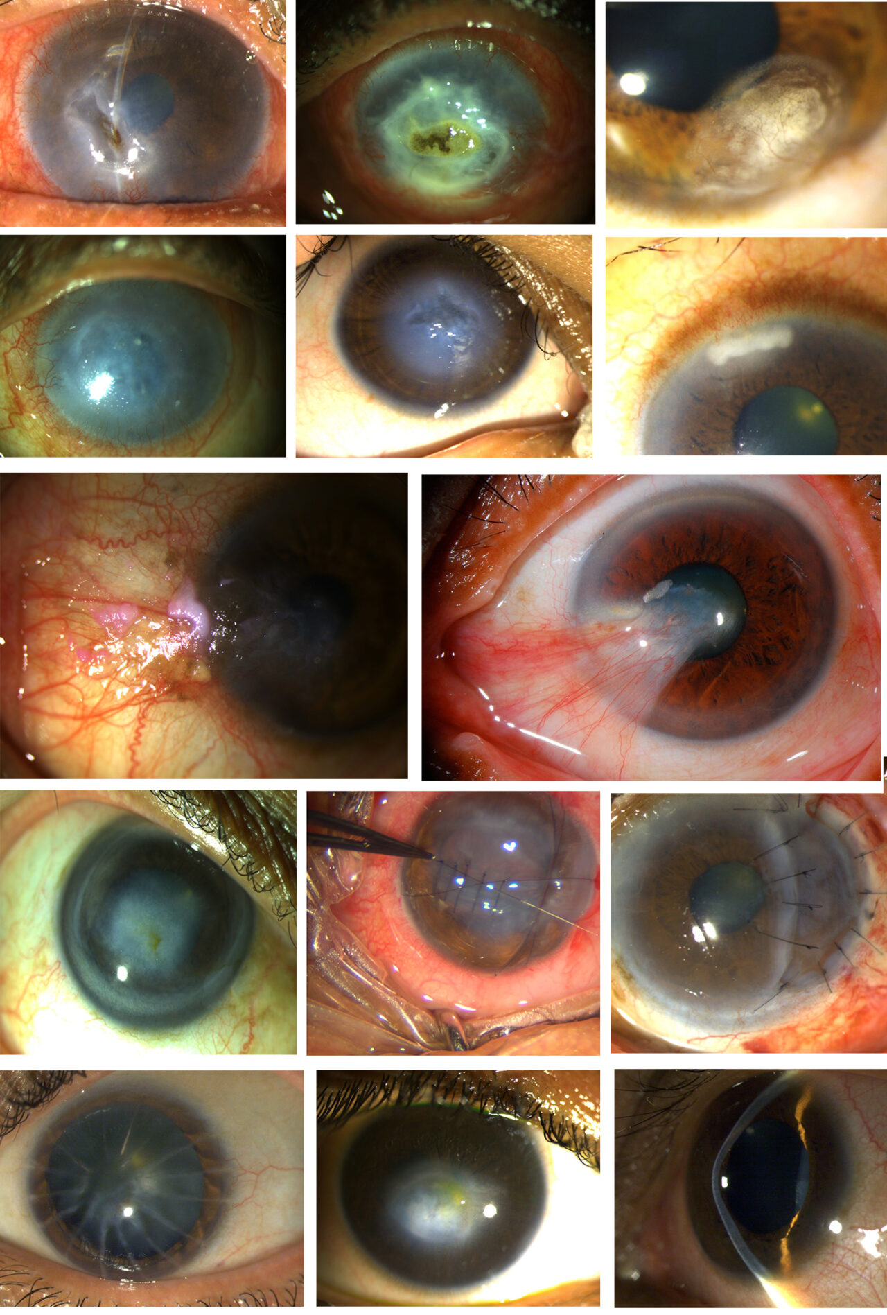 Eye Floaters - LJ Eye Institute - Patiala