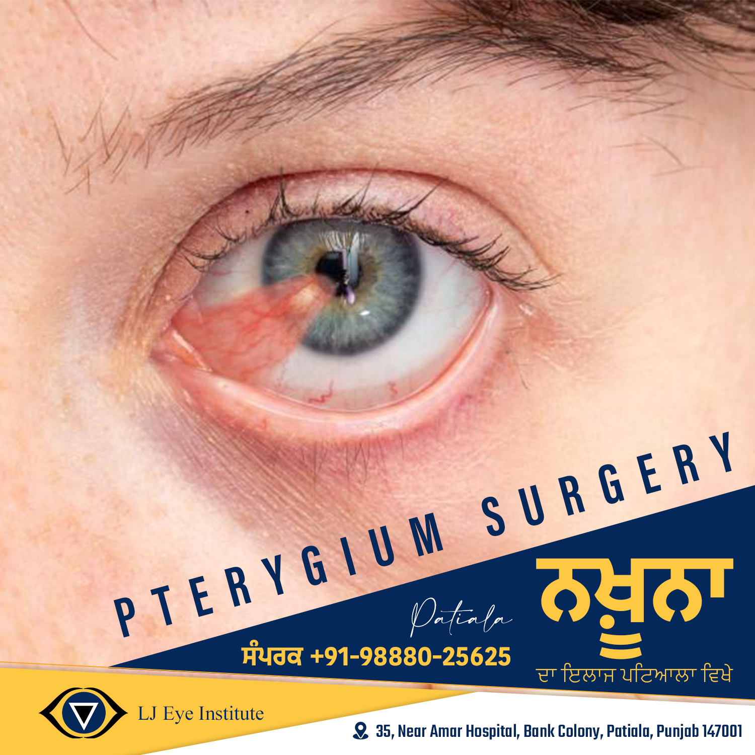 Pterygium: Causes, Symptoms & When to See an Eye Specialist - LJ Eye ...