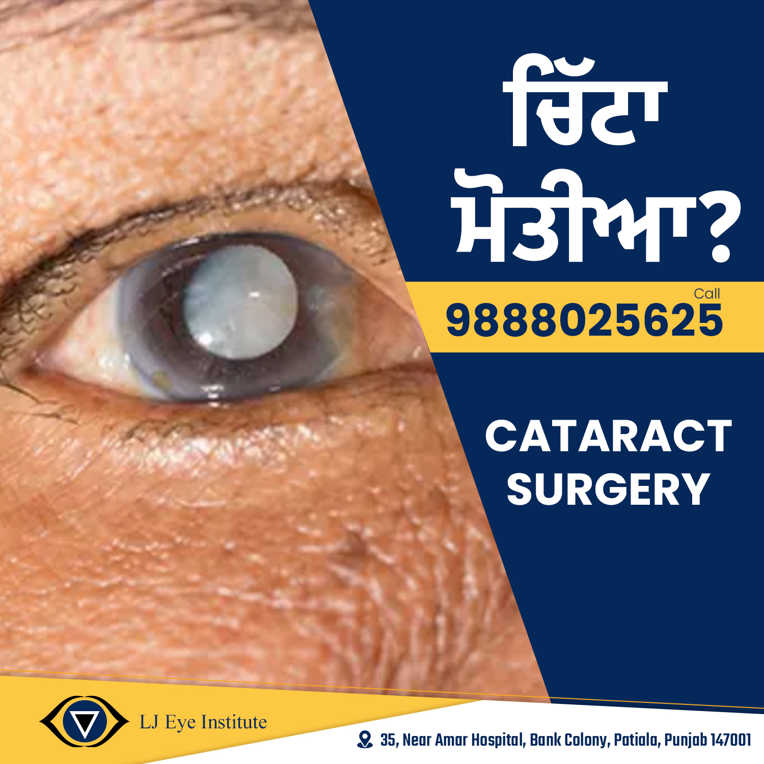 Cataract Surgery: Symptoms, Treatment Options & Recovery Guide - LJ Eye ...